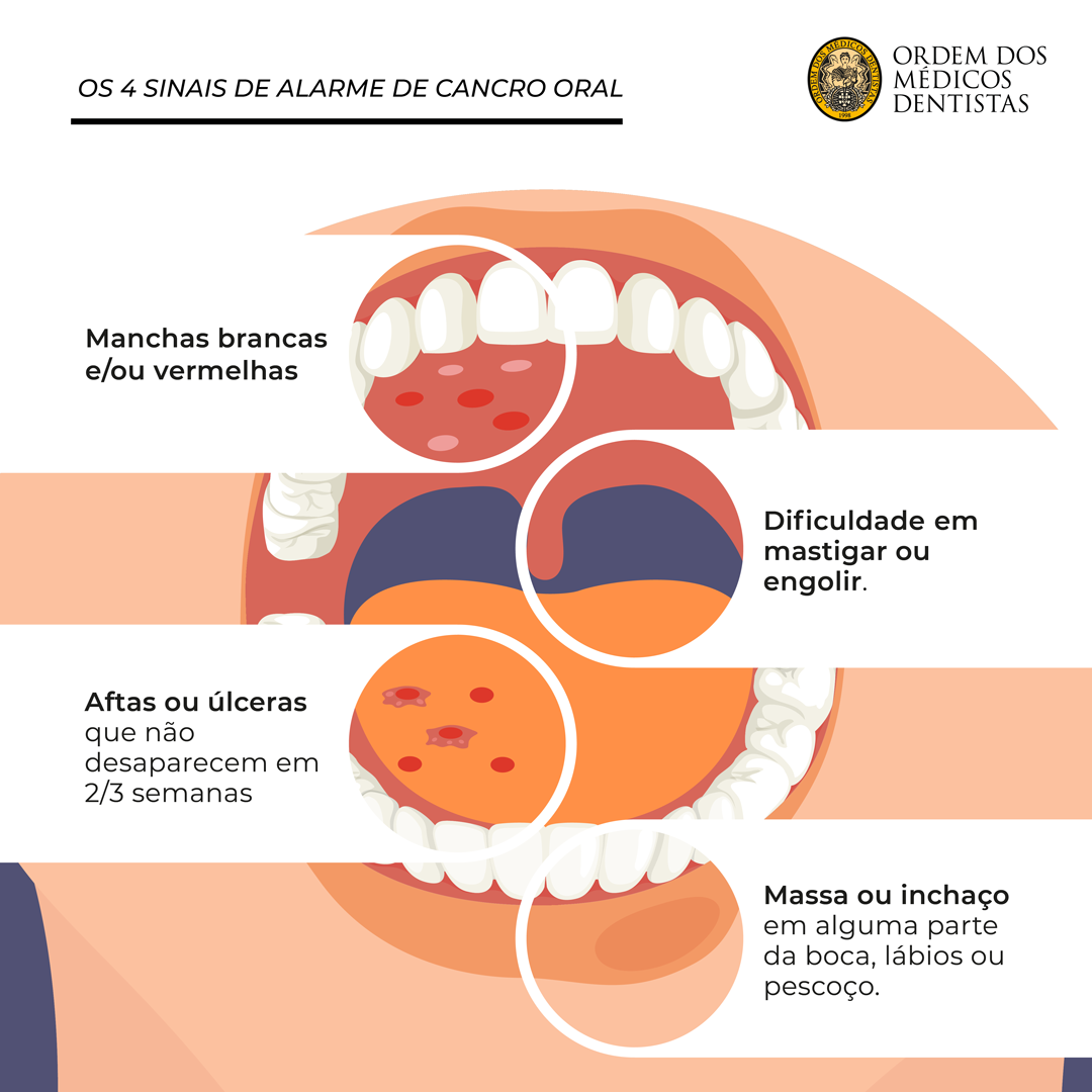 Sinais do cancro oral - Ordem dos Médicos Dentistas